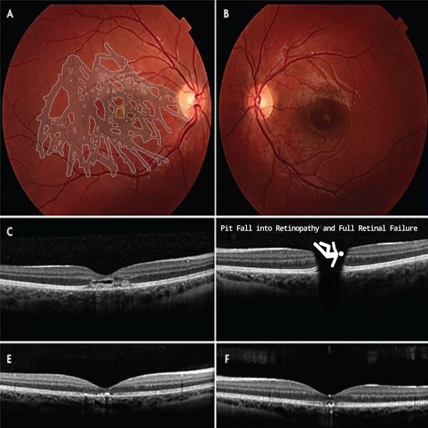 Pit Fall into Retinopathy and Full Retinal Failure, Optical Laceration ...